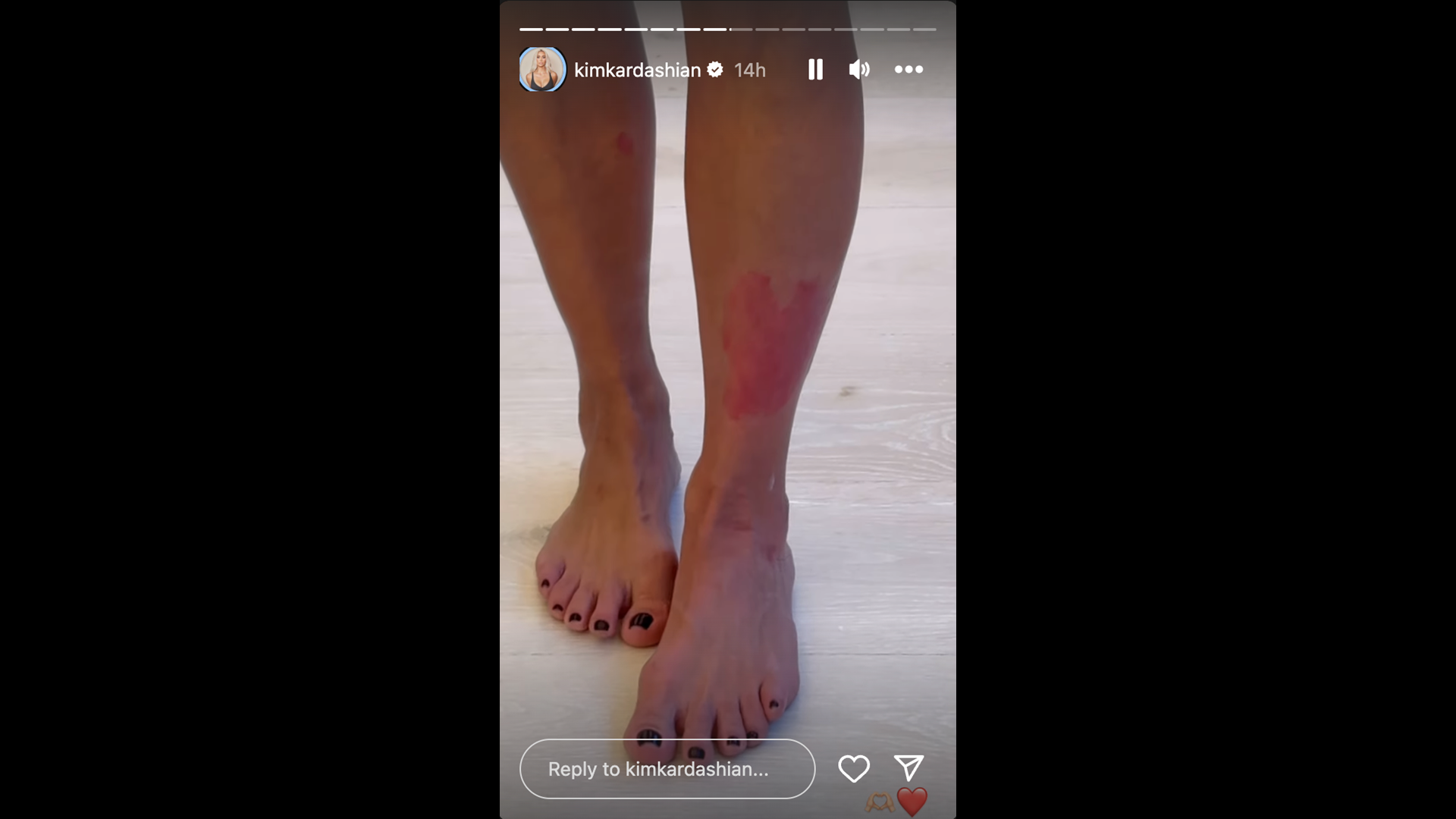 Kim Kardashian Reveals Her 'Painful' Psoriasis Flare-Up: ‘I’ve Got to ... Kim Kardashian Reveals Her 'Painful' Psoriasis Flare-Up: ‘I’ve Got to ...