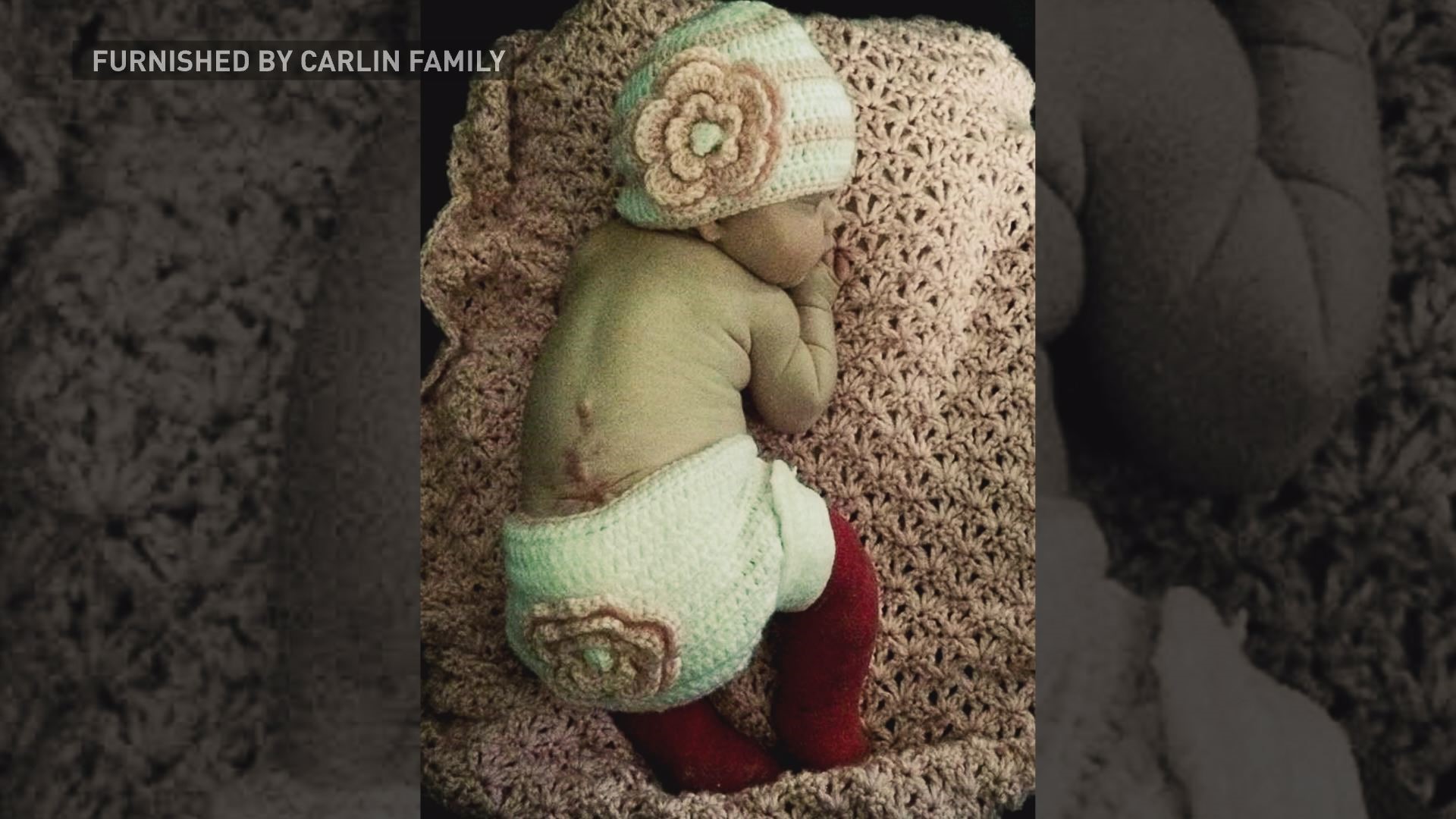 Fetal surgery for babies with spina bifida at Children's | kvue.com