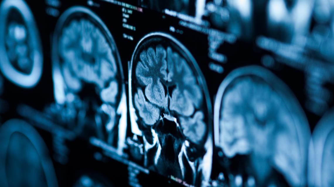 Paradromics announces first in-human implantation of brain-computer ...