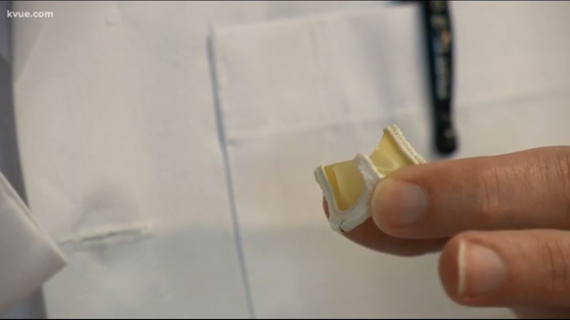 Austin woman first in Central Texas to get new heart valve with cow ...