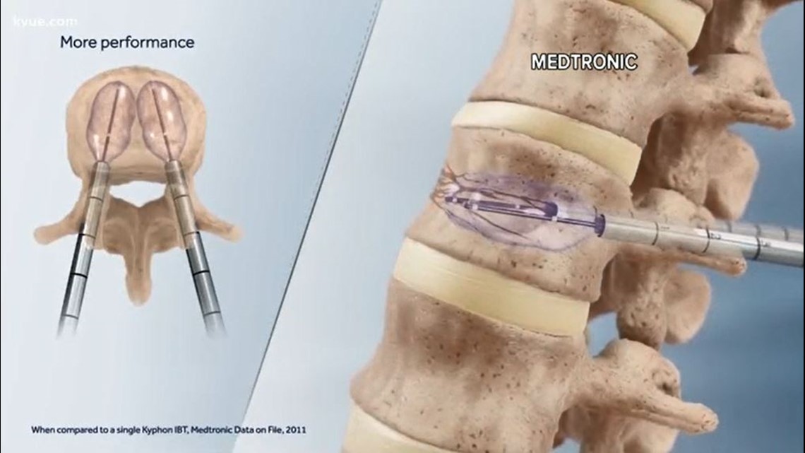 Austin doctors healing back injuries with balloons and cement | kvue.com
