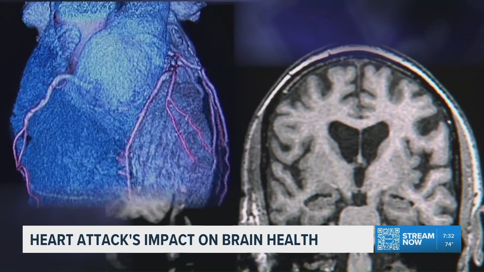 How heart attack survivors can work to protect their brain | kvue.com