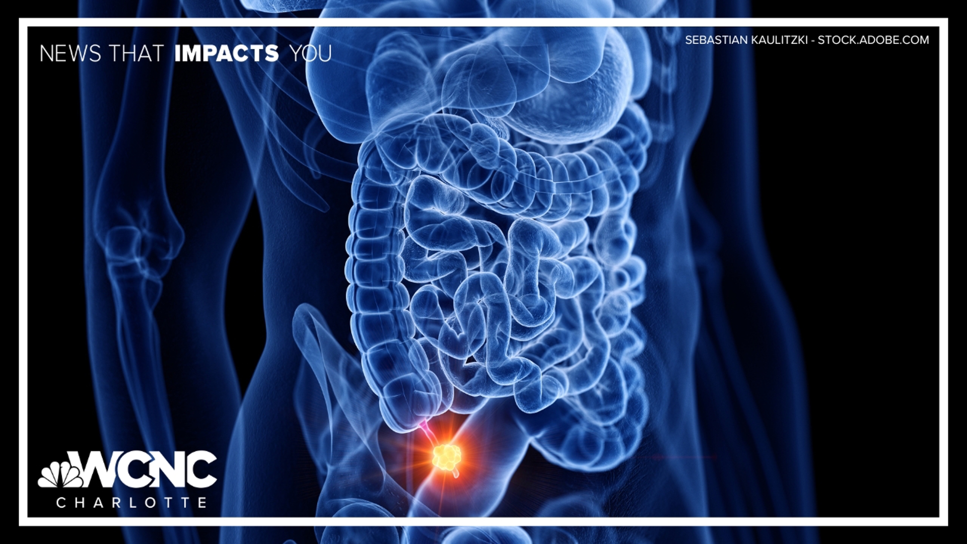 Appendix cancer rates surge among Gen X and millennials | kvue.com