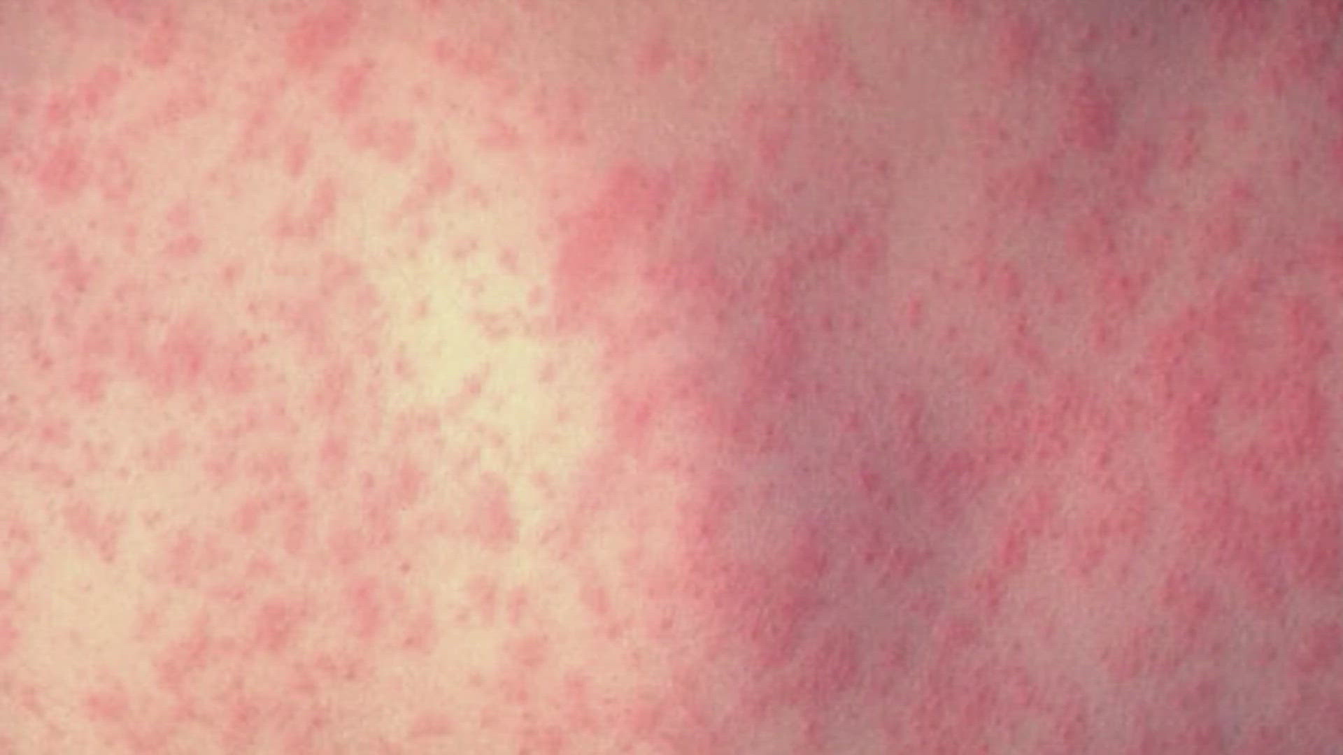 Texas measles outbreak: DSHS reports 124 cases | kvue.com