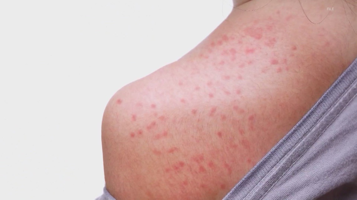 CDC in Texas to respond to measles outbreak | kvue.com